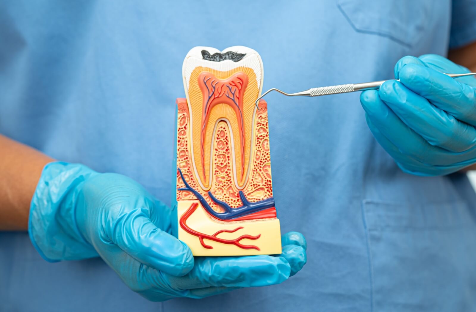 How to Avoid a Root Canal | Fairlawn Dental Centre | Ottawa