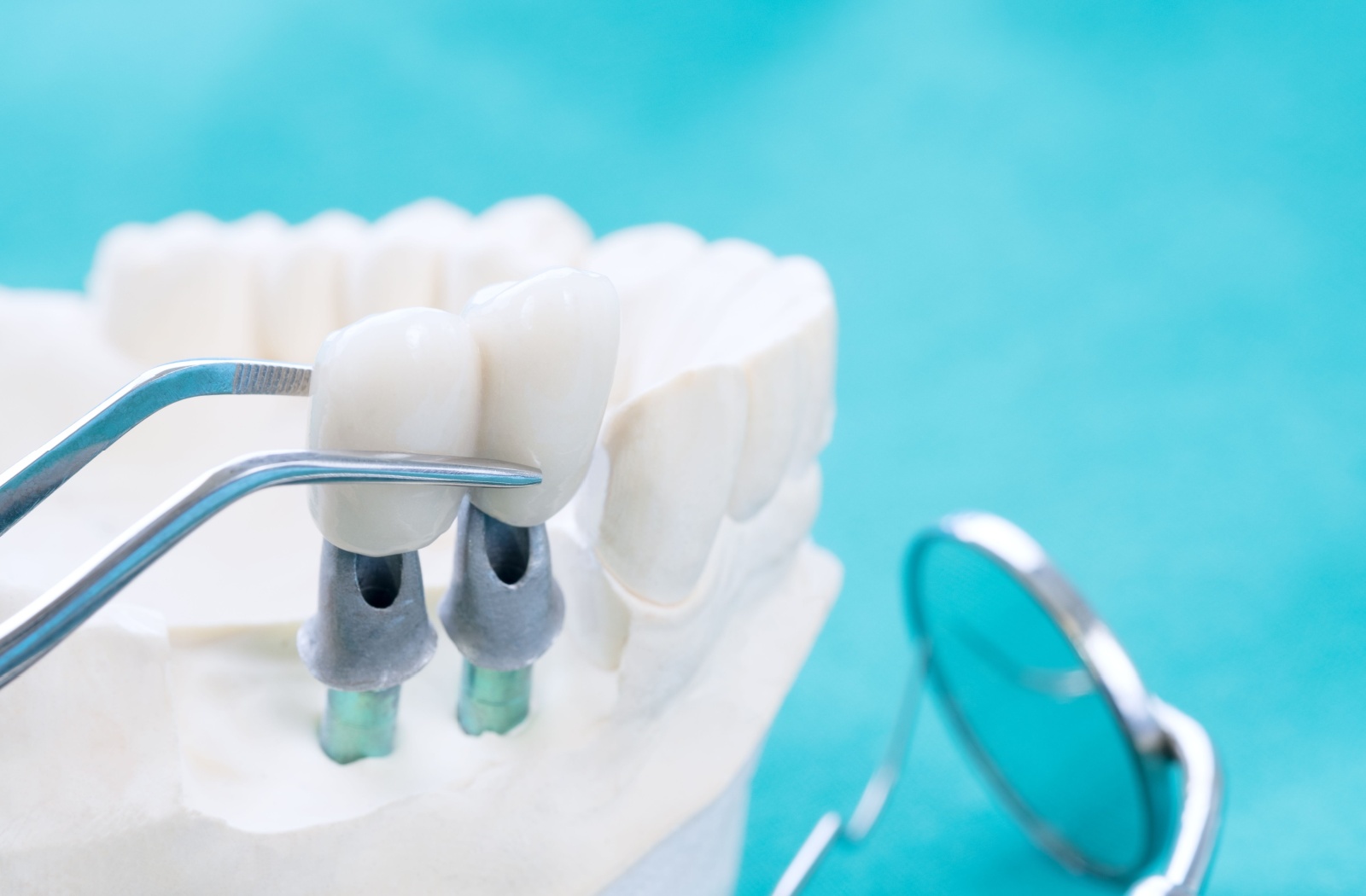 How to Clean & Care for a Dental Bridge | Fairlawn Dental Centre